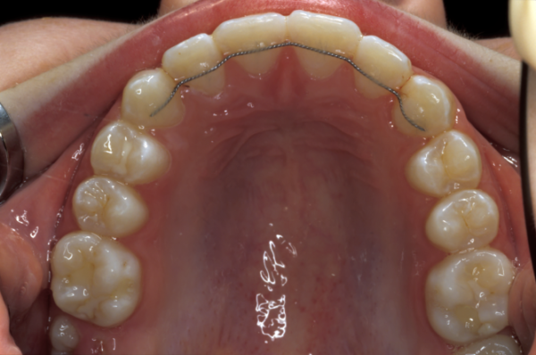 Permanente Retainer – Praxis Serbesis